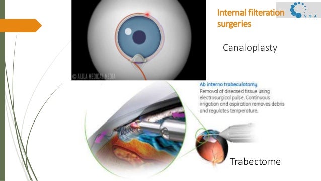 Primary open angle glaucoma – surgical management