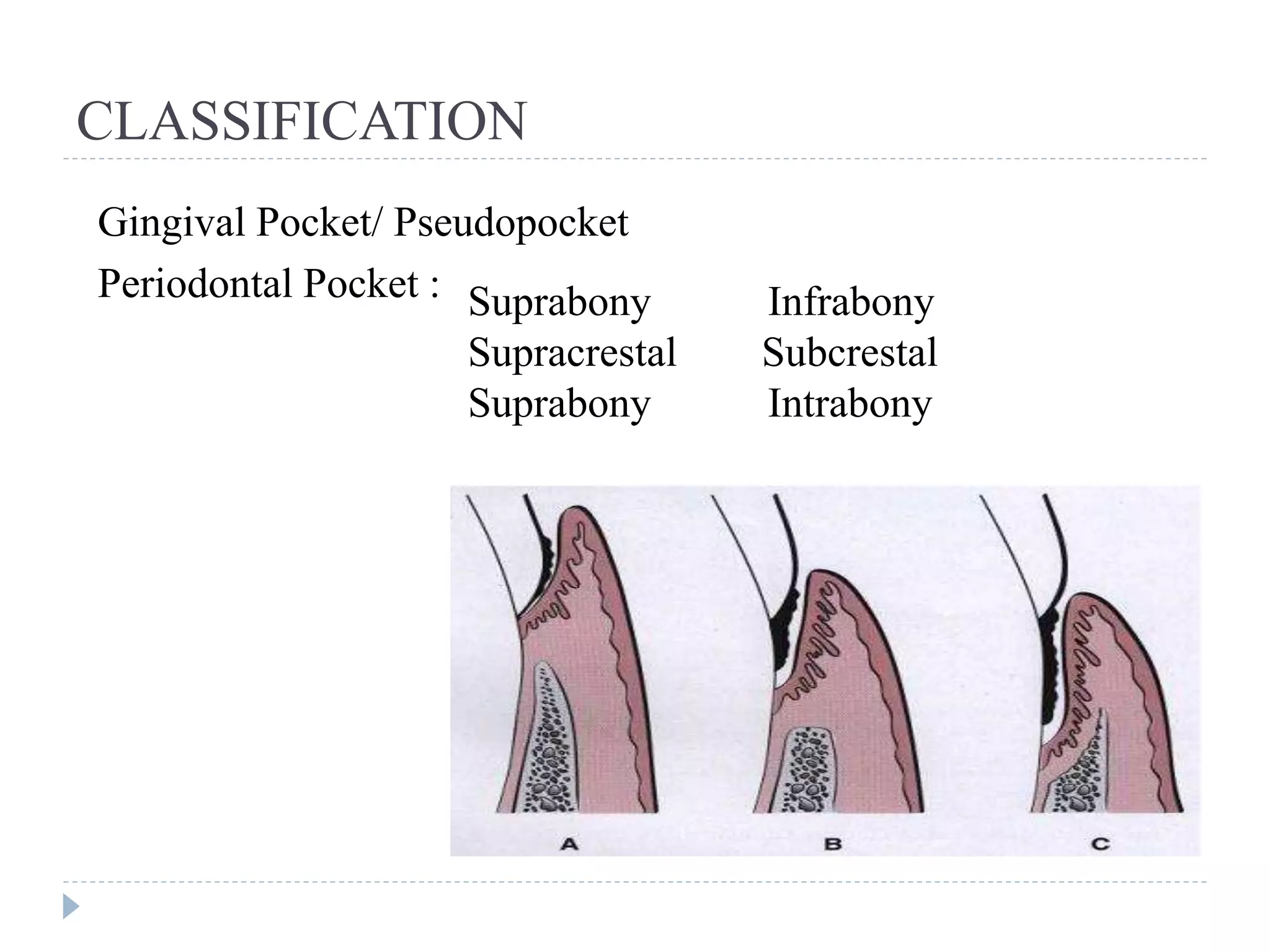 Periodontal Pocket | PPTX