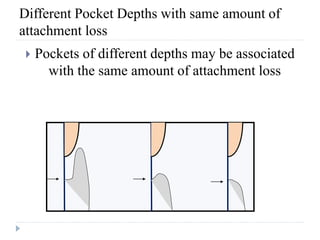 Periodontal Pocket | PPT