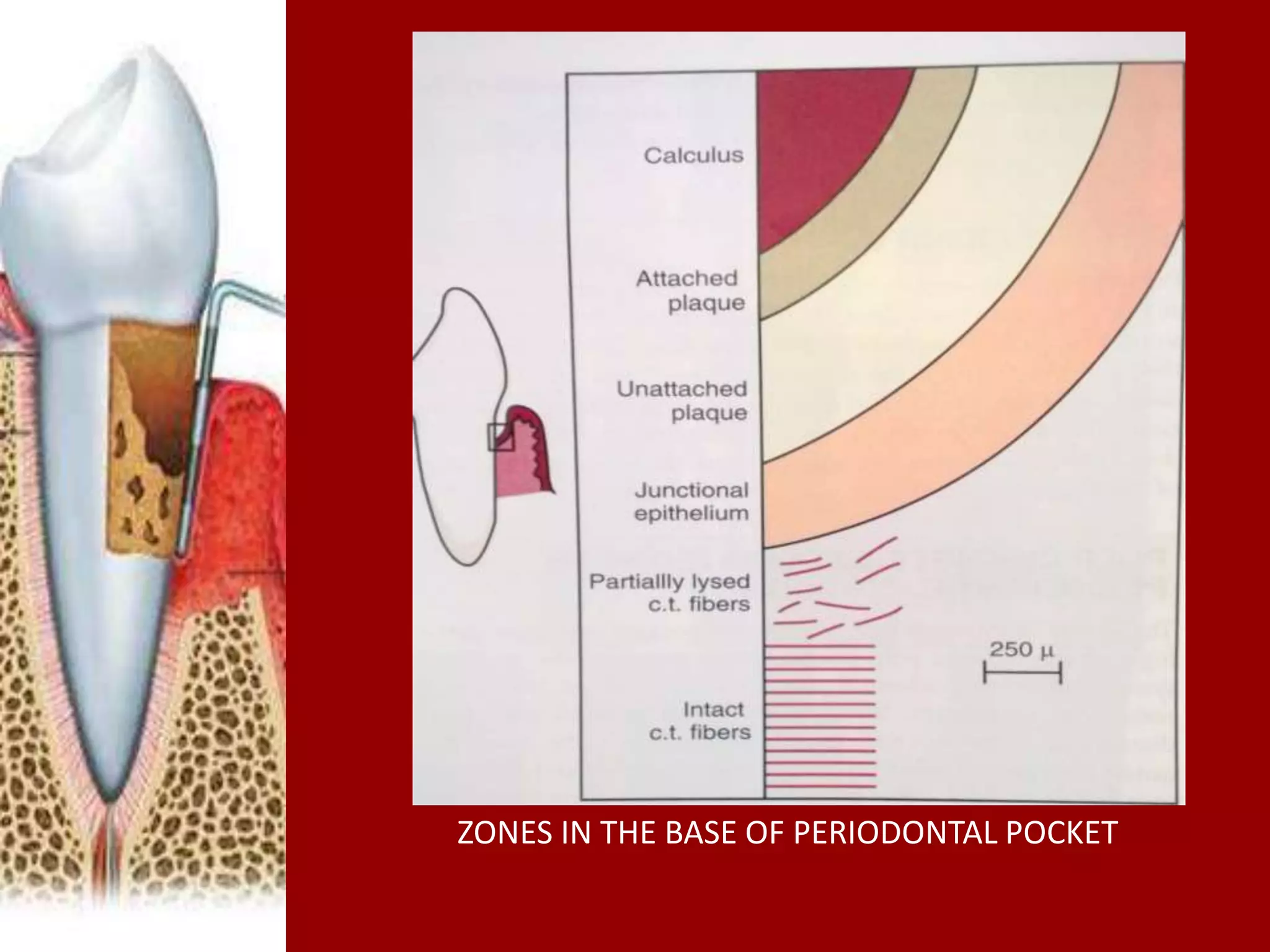 Periodontal Pockets | PPTX