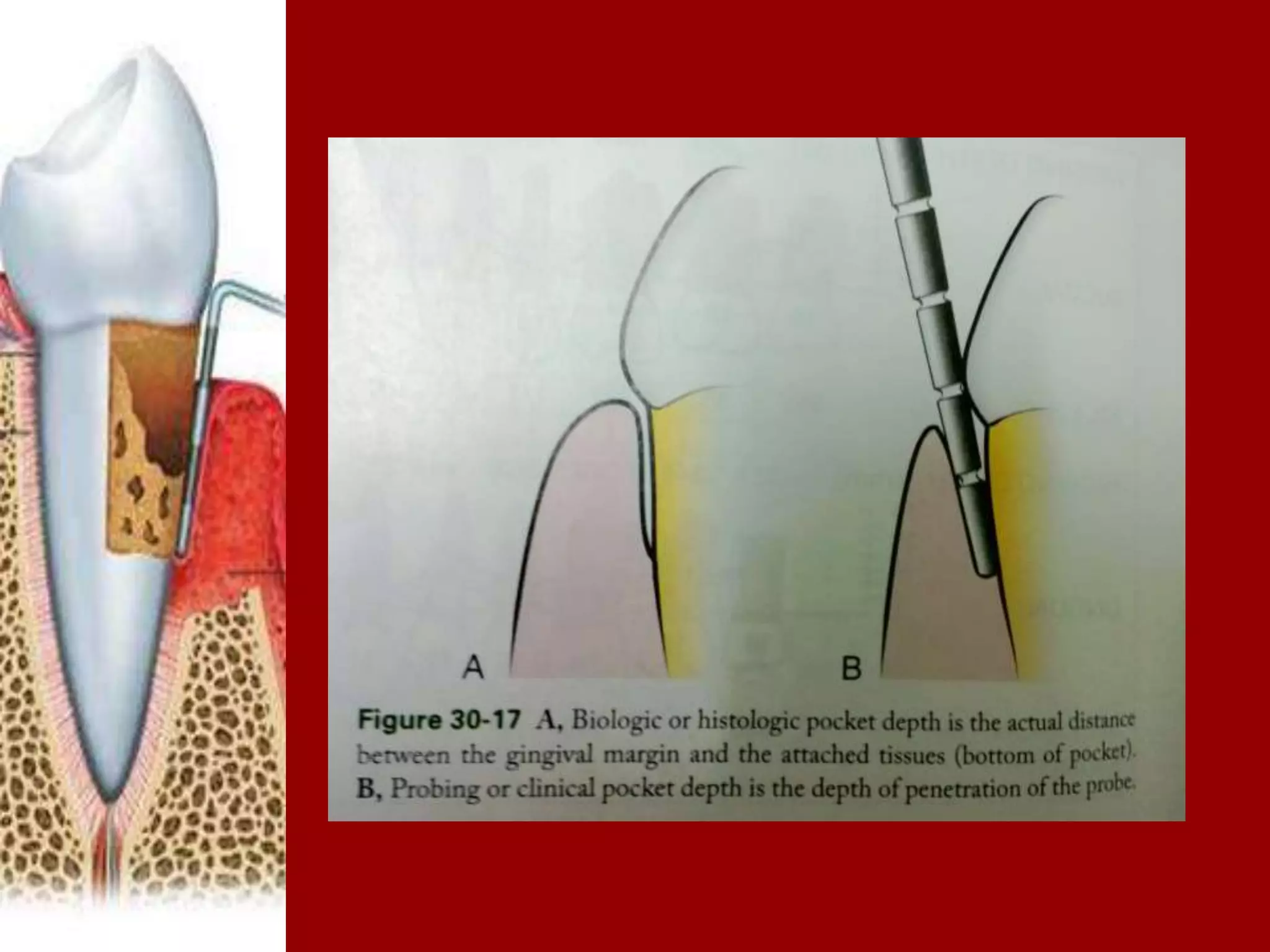 Periodontal Pockets | PPTX