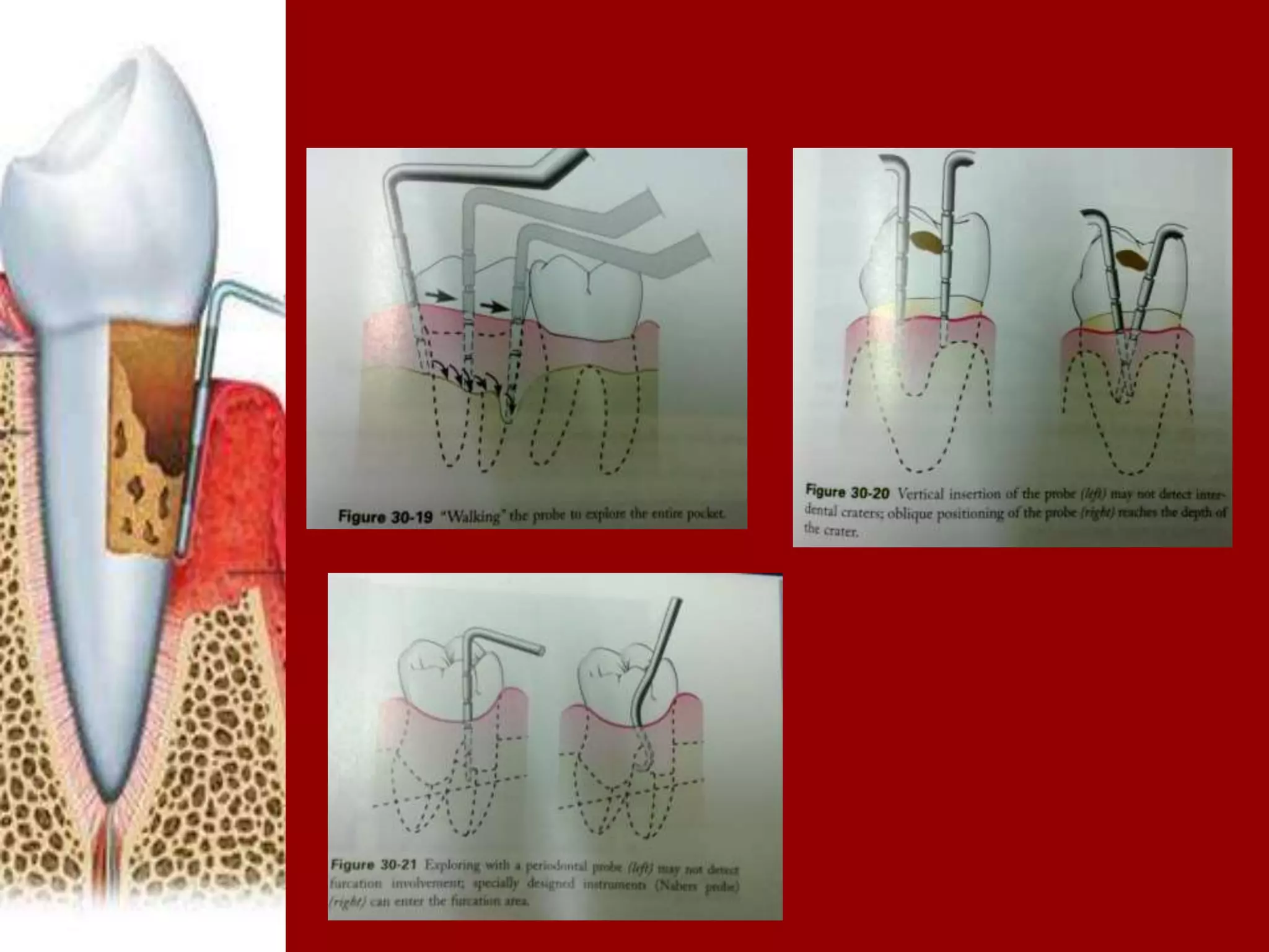 Periodontal Pockets | PPTX