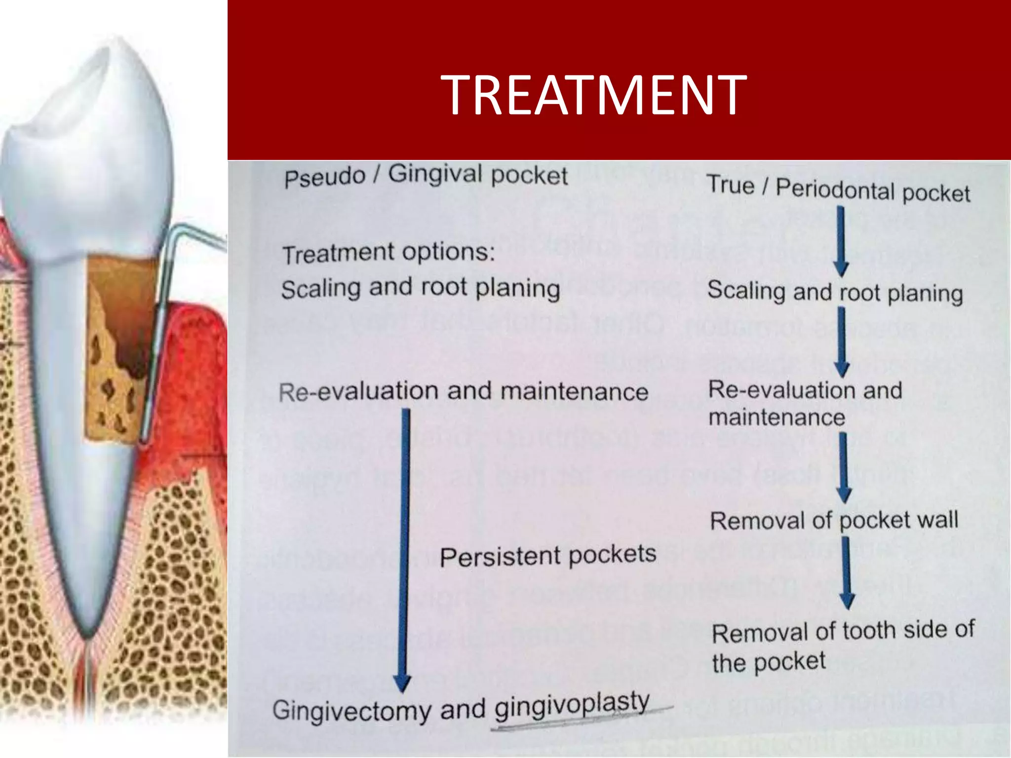 Periodontal Pockets | PPTX