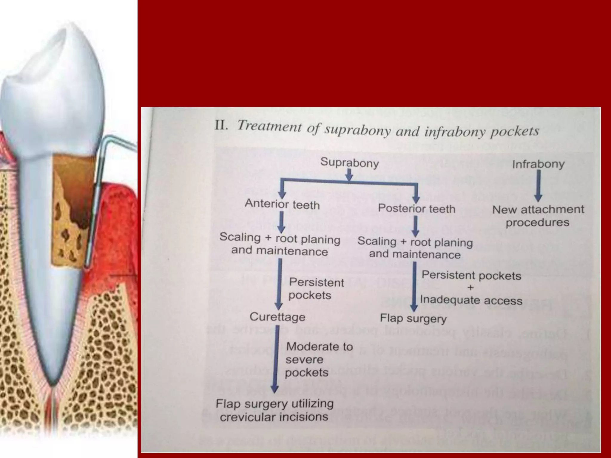Periodontal Pockets | PPTX