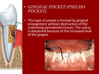 Periodontal Pockets | PPTX