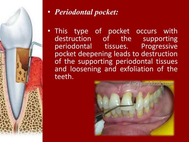 Periodontal Pockets | PPTX