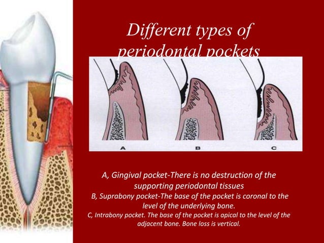 Periodontal Pockets | PPTX