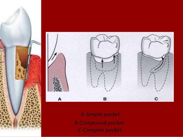 Periodontal Pockets