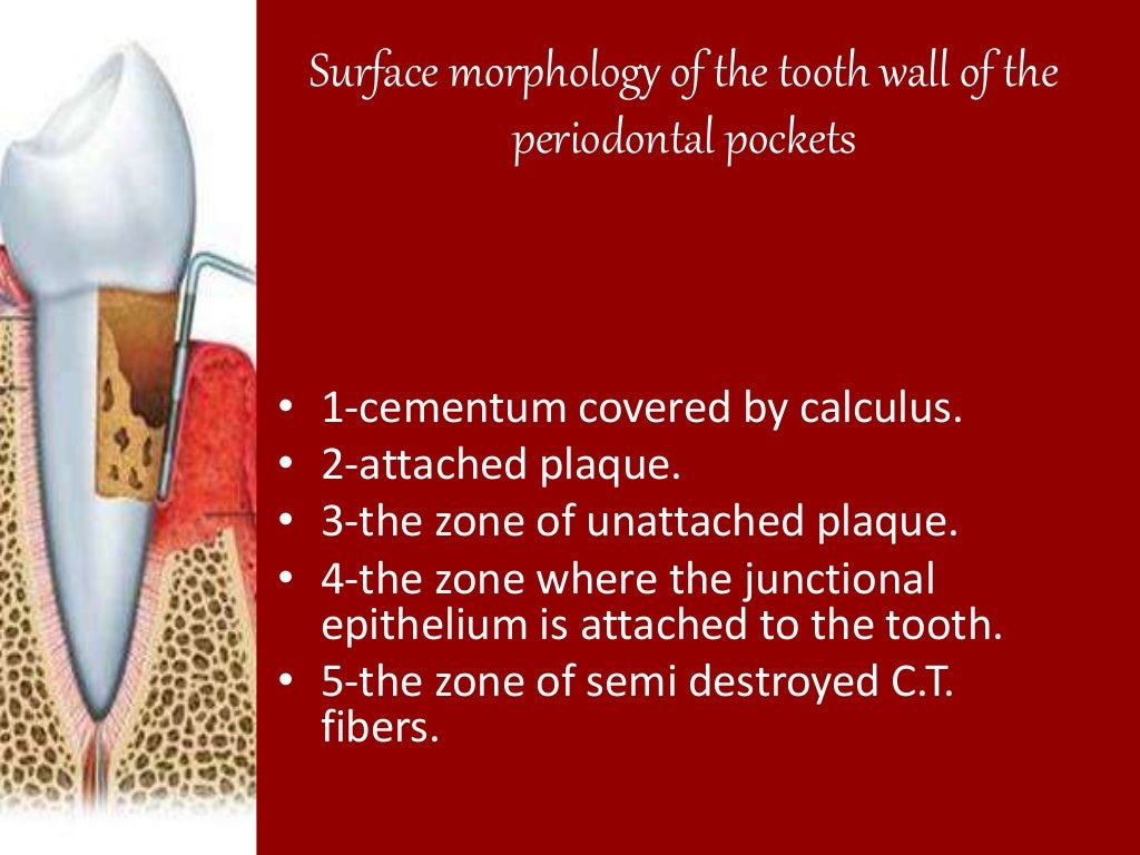 Periodontal Pockets