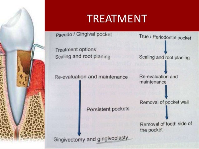 Periodontal Pockets