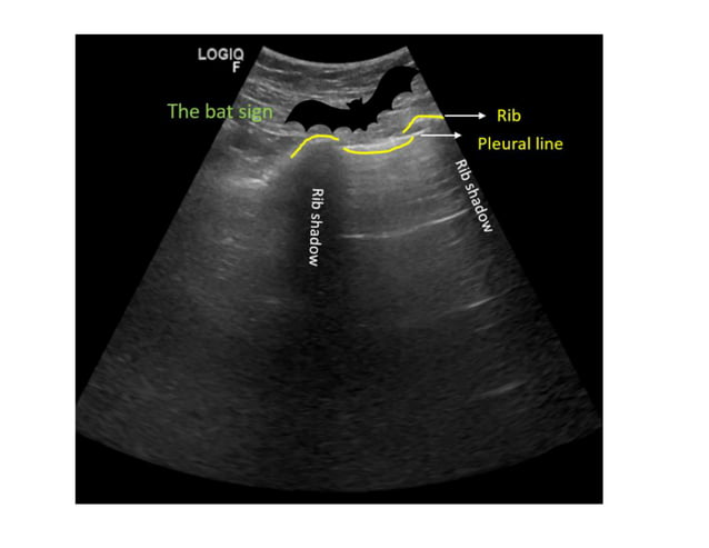 POCUS | PDF