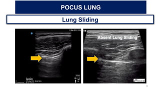 POCUS -Neonatal Ultrasound Images for knowledge | PPTX