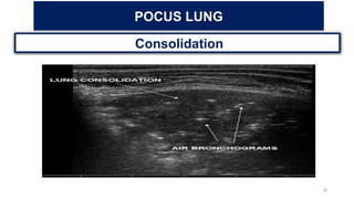 POCUS -Neonatal Ultrasound Images for knowledge | PPTX