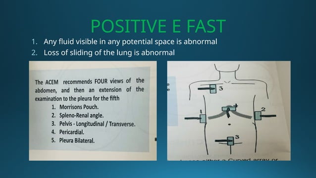 Pocus-point of care ultrasound is a portable ultrasound machine that ...