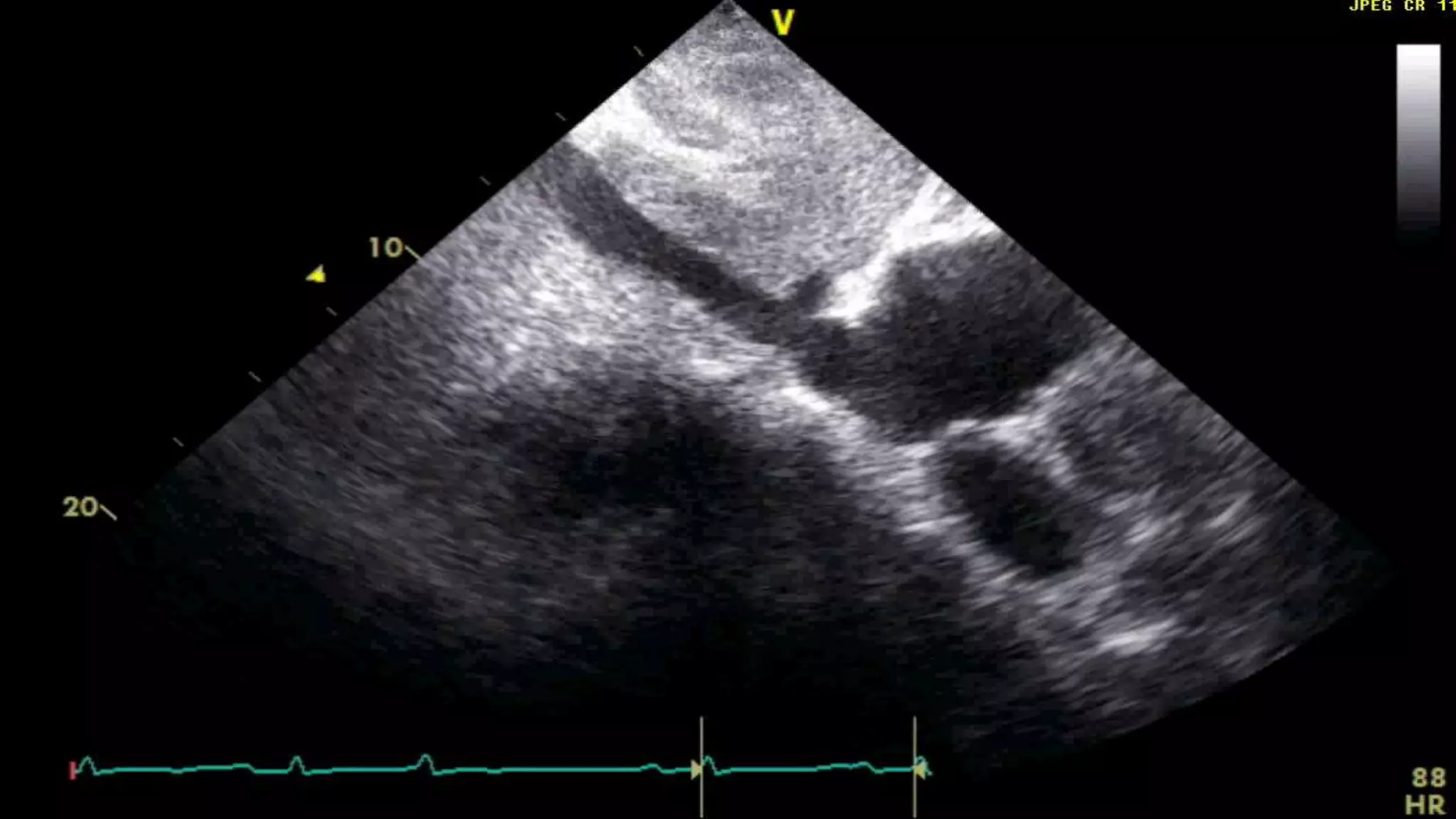Pocus and deresuscitation | PPTX