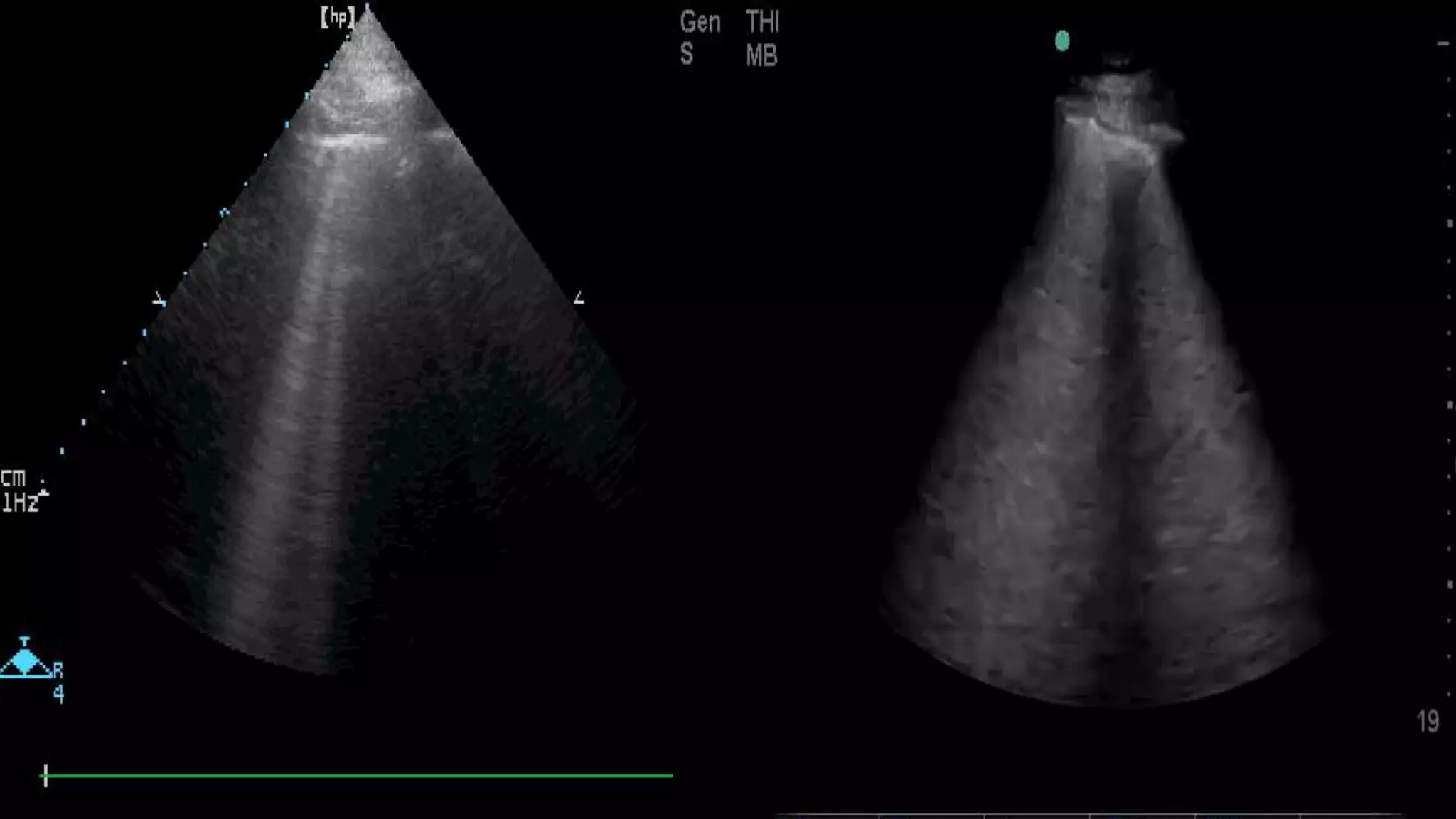 Pocus and deresuscitation | PPTX