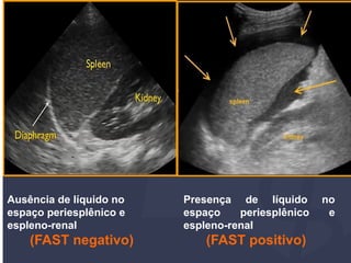 Protocolo FAST POCUS | PDF