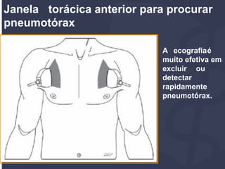 Protocolo FAST POCUS | PDF