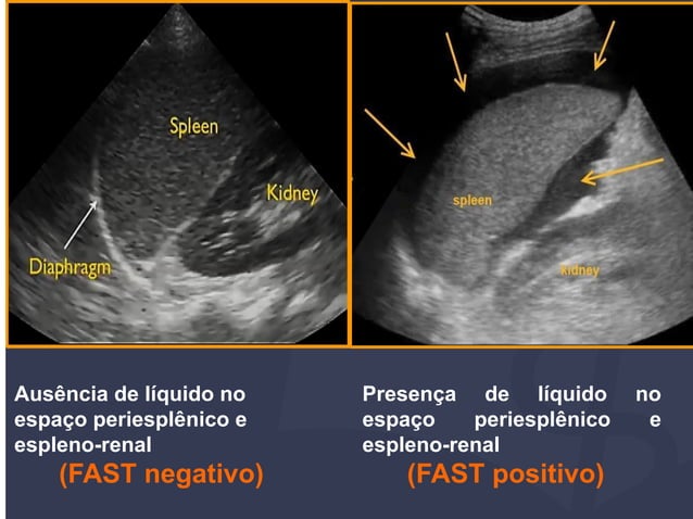 Protocolo FAST POCUS