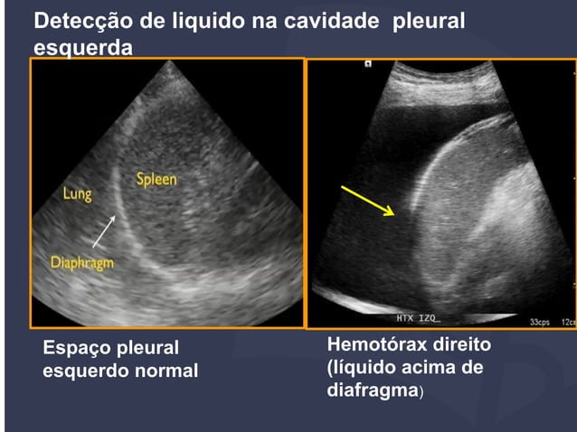 Protocolo FAST POCUS