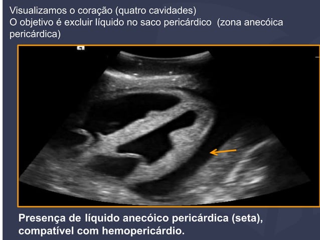 Protocolo FAST POCUS