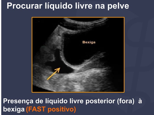Protocolo FAST POCUS