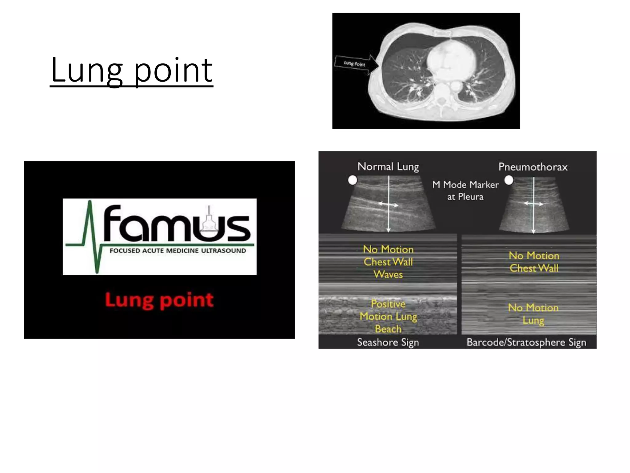 POCUS for dyspnea.pptx