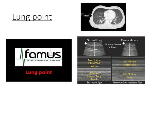 POCUS for dyspnea.pptx | Lung and Respiratory Health | Diseases and ...
