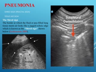 APPROACH TO POCUS IN ACUTE RESPIRATORY FAILURE.pptx