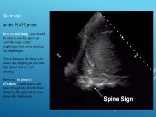 APPROACH TO POCUS IN ACUTE RESPIRATORY FAILURE.pptx