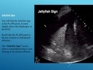 APPROACH TO POCUS IN ACUTE RESPIRATORY FAILURE.pptx
