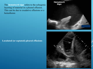 APPROACH TO POCUS IN ACUTE RESPIRATORY FAILURE.pptx