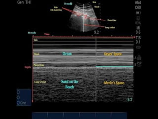 APPROACH TO POCUS IN ACUTE RESPIRATORY FAILURE.pptx