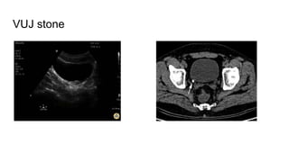 Point Of Care UltraSound in Urology ( POCUS ) | PPTX