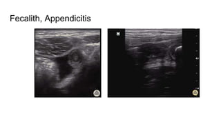 Point Of Care UltraSound in Urology ( POCUS ) | PPTX