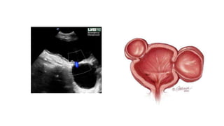 Point Of Care UltraSound in Urology ( POCUS ) | PPTX