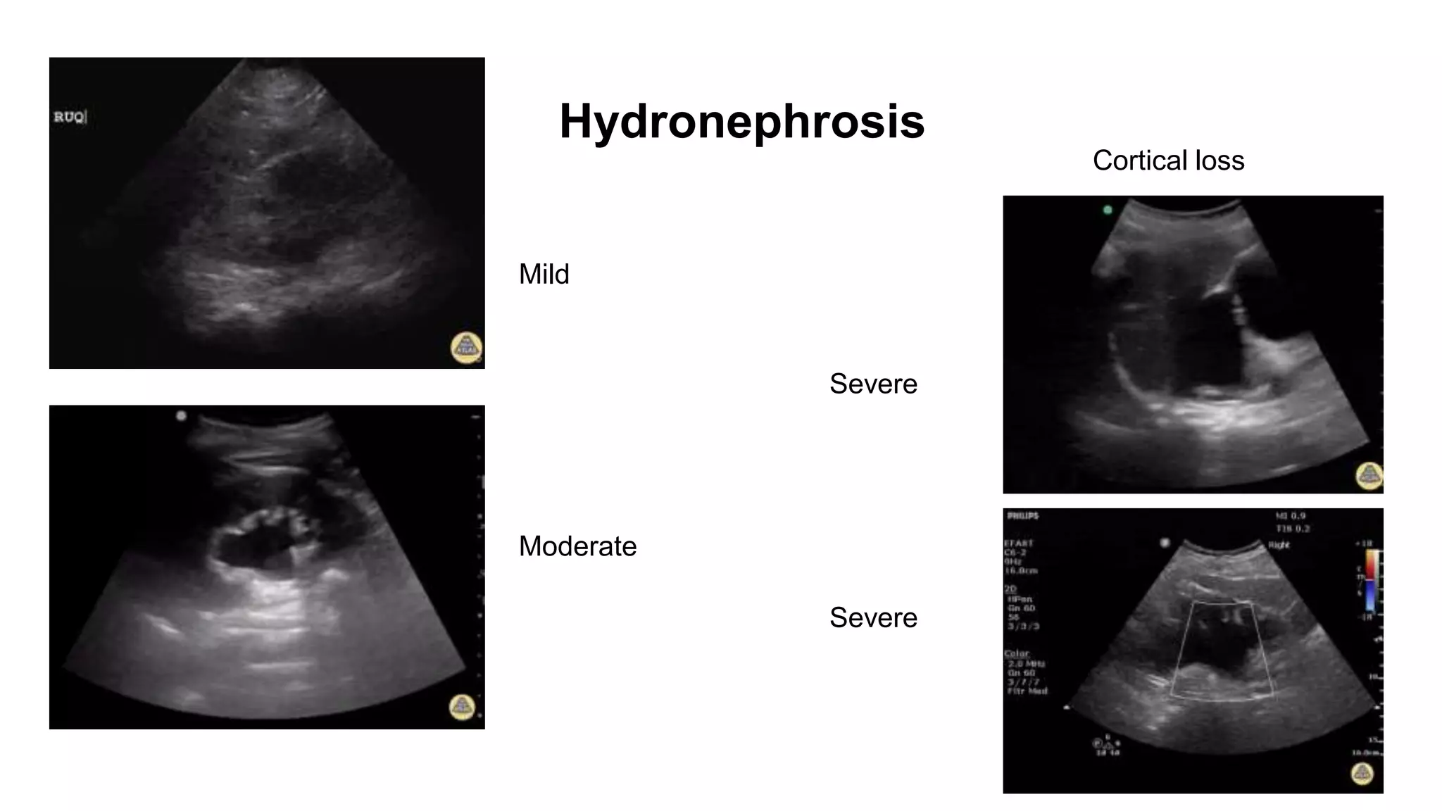 Point of Care Ultrasound ( urology ) | PPTX