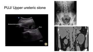Point of Care Ultrasound ( urology ) | PPTX