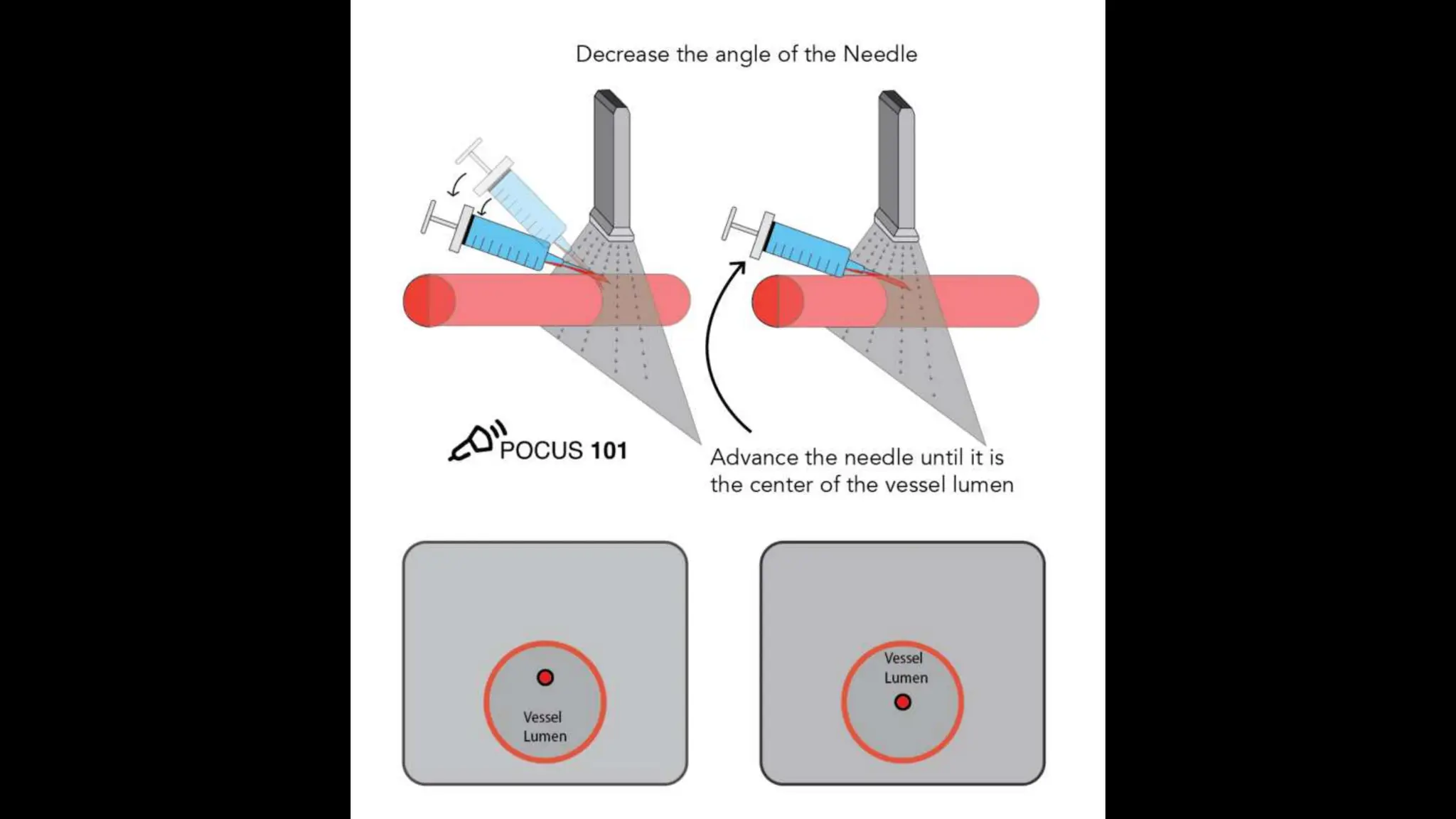 Vascular Access using POCUS Principles and Techniques | PPTX