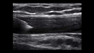 Vascular Access using POCUS Principles and Techniques | PPTX