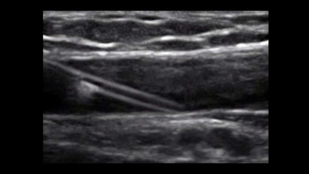 Vascular Access using POCUS Principles and Techniques | PPTX