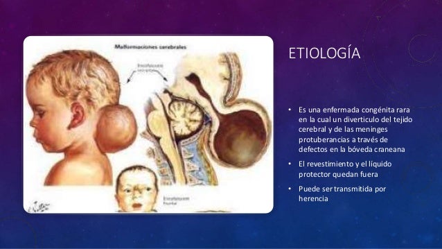 Defectos del tubo neural