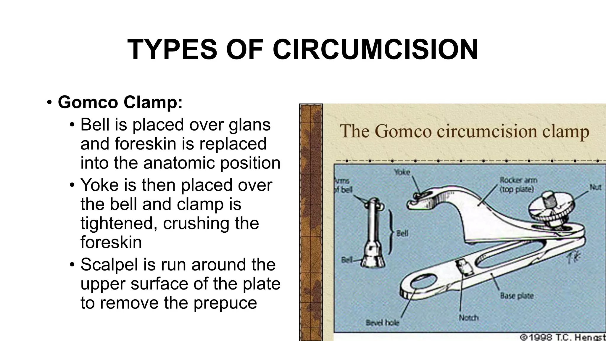 Penile abnormalities | PPTX
