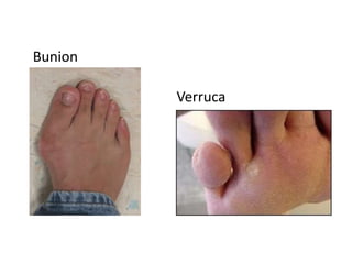 Homeless Podiatry Feet on the Street | PPTX | Foot Health | Diseases ...