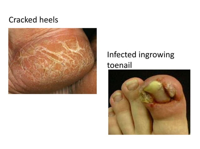 Homeless Podiatry Feet on the Street | PPTX | Foot Health | Diseases ...