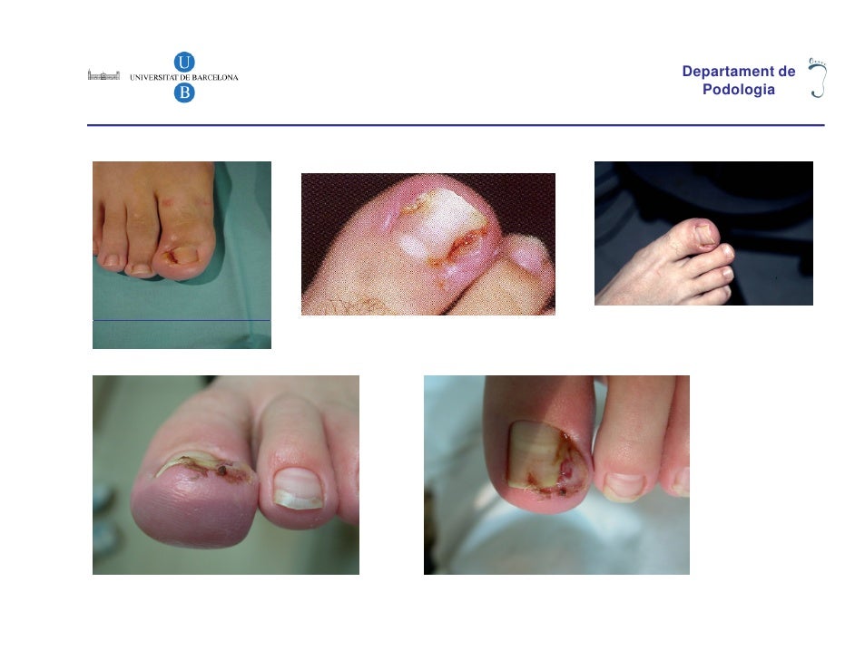 Podologia onicocriptosis