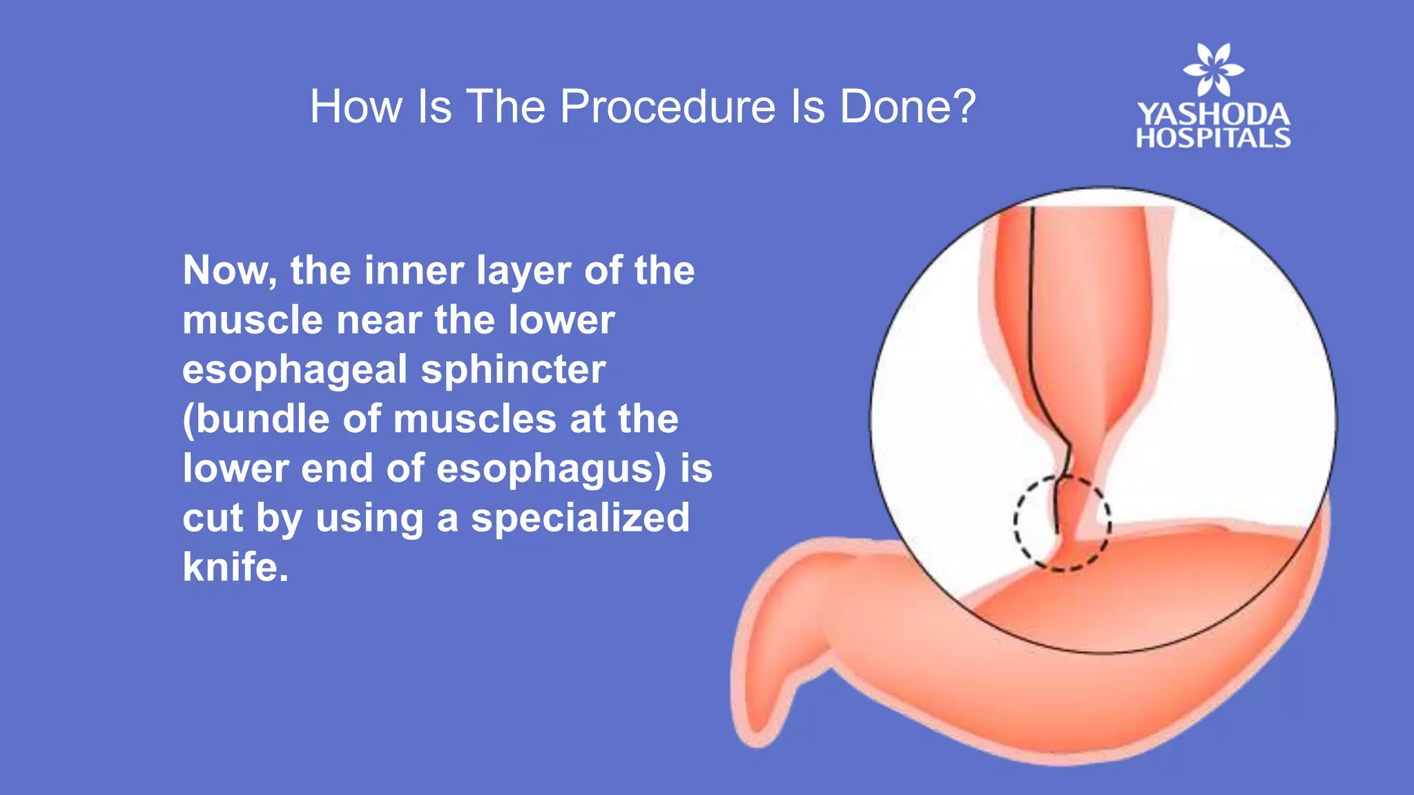 Peroral Endoscopic Myotomy (POEM) | Treatment For Achalasia of ...