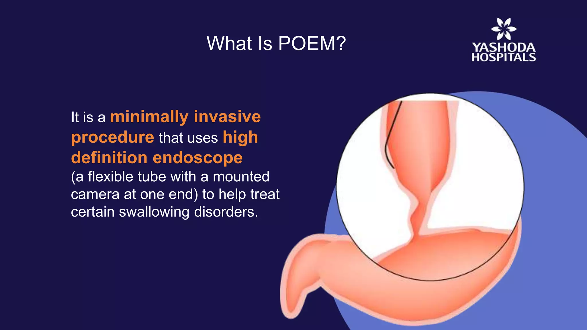 Peroral Endoscopic Myotomy (POEM) | Treatment For Achalasia of ...