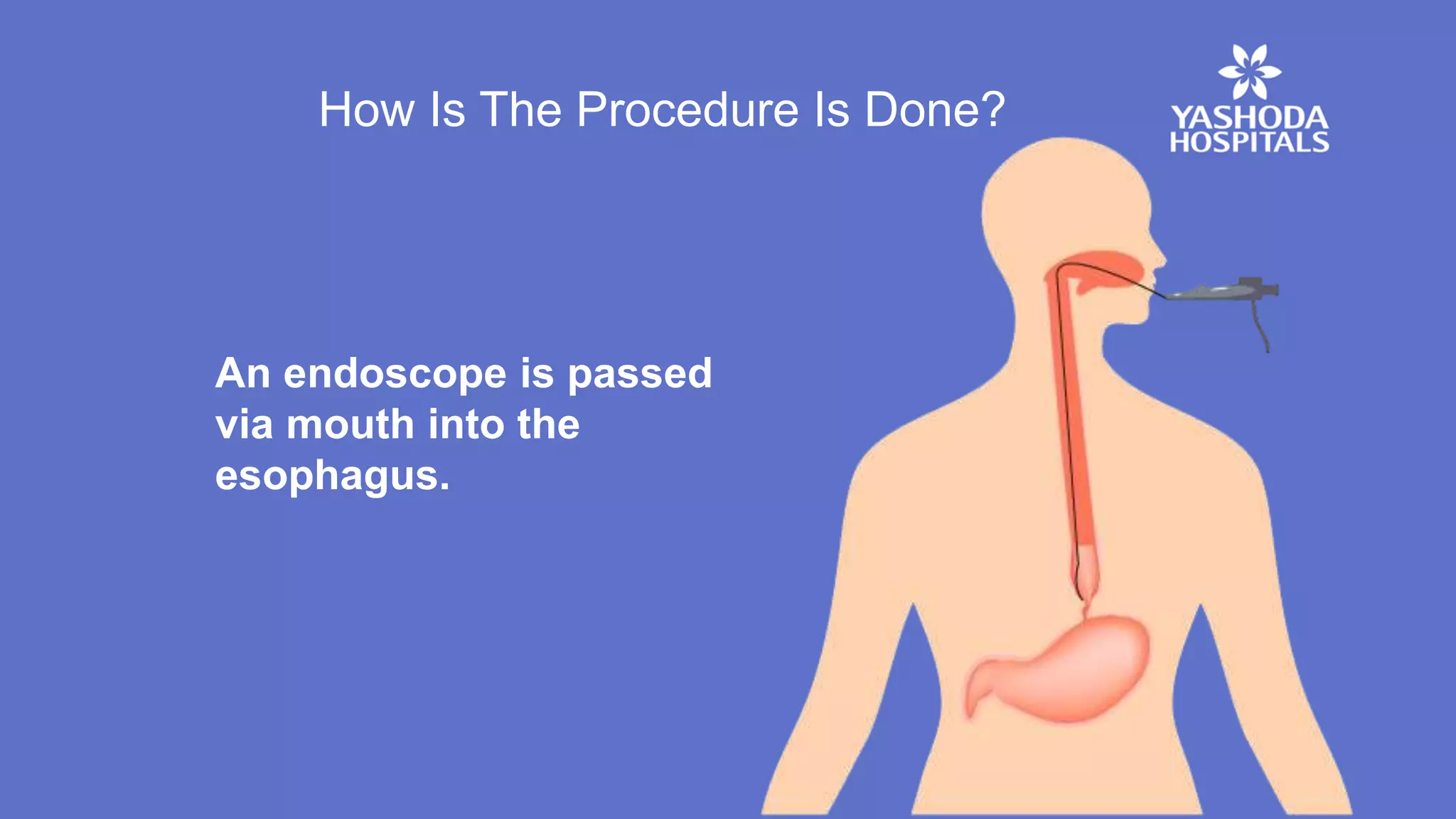 Peroral Endoscopic Myotomy (POEM) | Treatment For Achalasia of ...