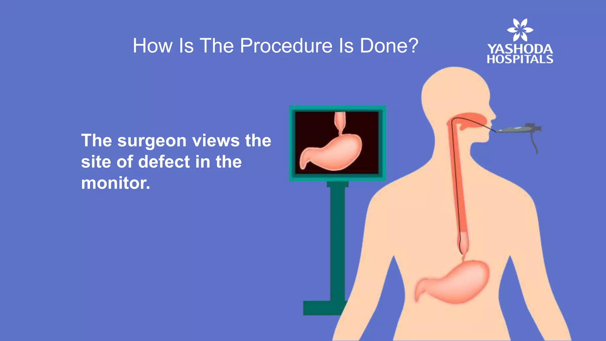 Peroral Endoscopic Myotomy (POEM) | Treatment For Achalasia of ...